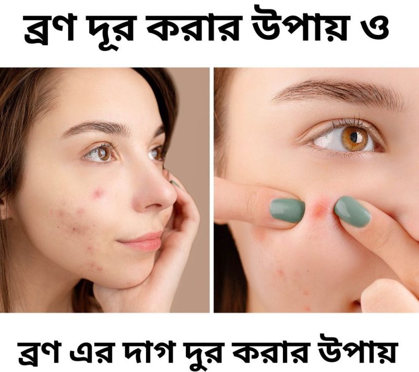 ব্রণ দূর করার উপায় ও ব্রন এর দাগ দূর করার ঘরোয়া উপায় - BD Archives